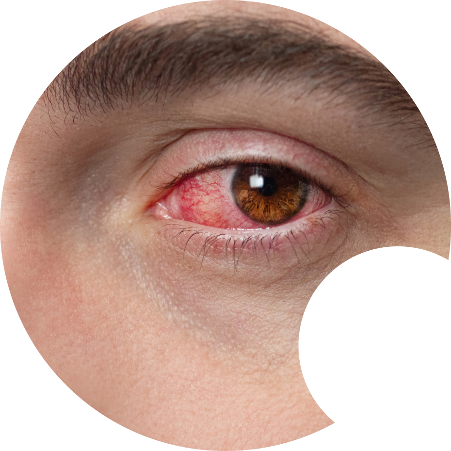 Blepharitis Sore Itchy Red Eye Causes And Symptoms Causes,
