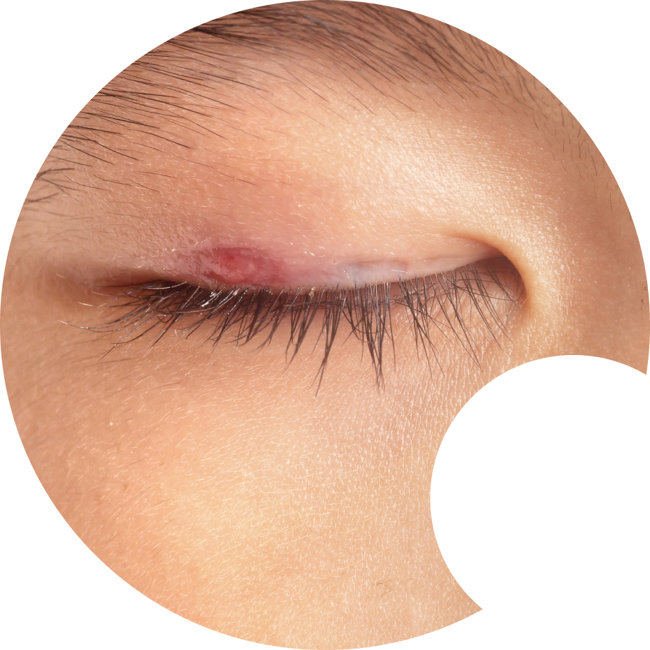 Stye - Symptoms and Causes - Liverpool