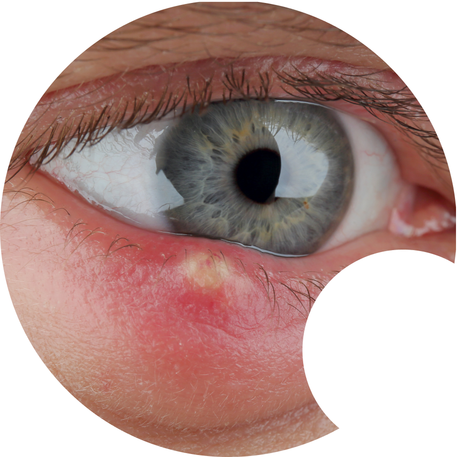 Stye - Symptoms and Causes - Liverpool