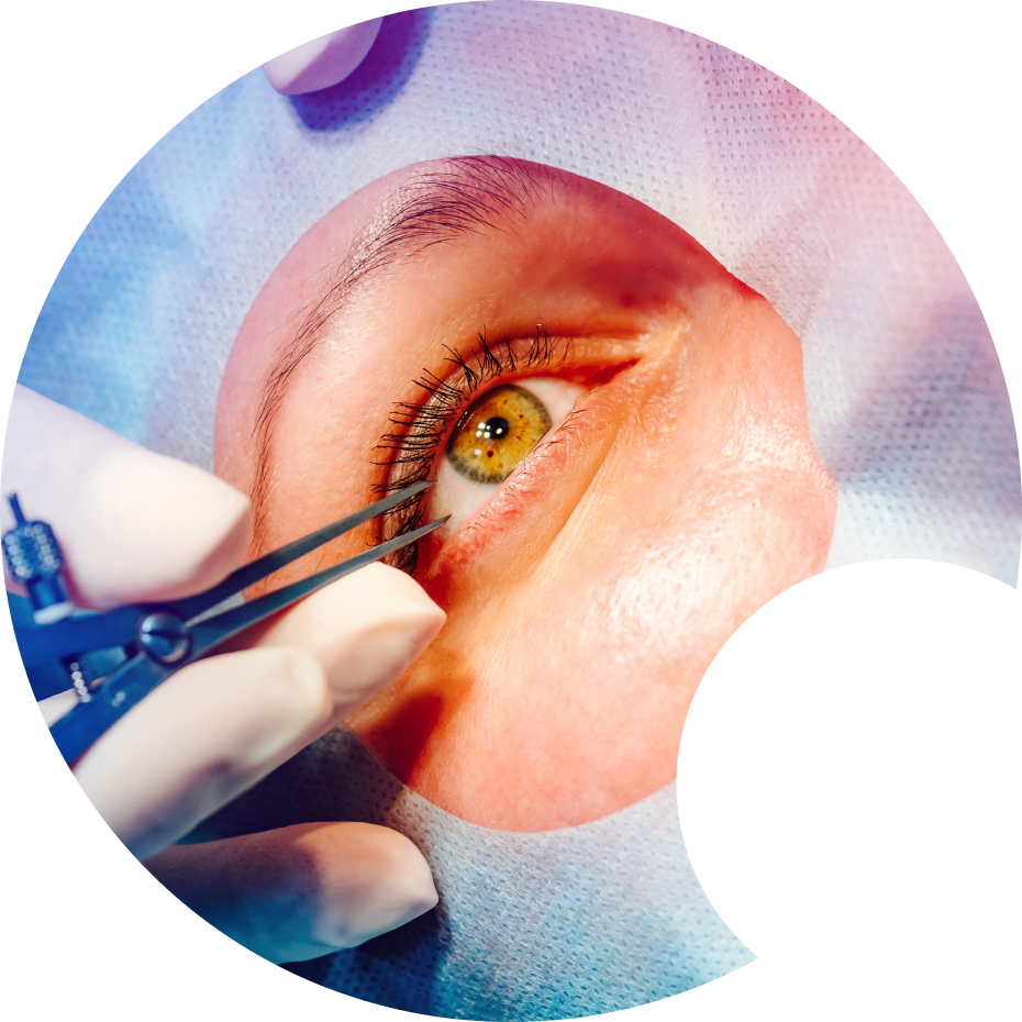 Glaucoma Surgery ESCRS CID: A New Pathway For Glaucoma Surgery